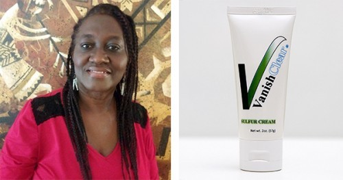 Black Mom Solves Fungal Skin Infection Problem Called Tinea Versicolor